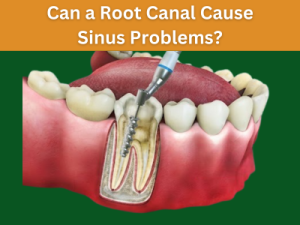 Can a Root Canal Cause Sinus Problems? Ask our dentists